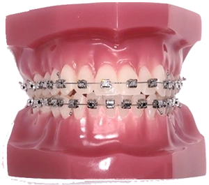 FK Dental - Tipodontos de Acrilico con brackets ligados y autoligados